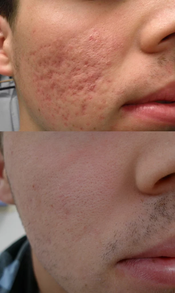Acne Scars Cutis Dermatology