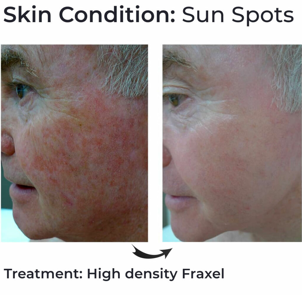 Best Fraxel Laser Packages Brisbane - Cutis Dermatology Best Fraxel Laser Packages Brisbane - Cutis Dermatology