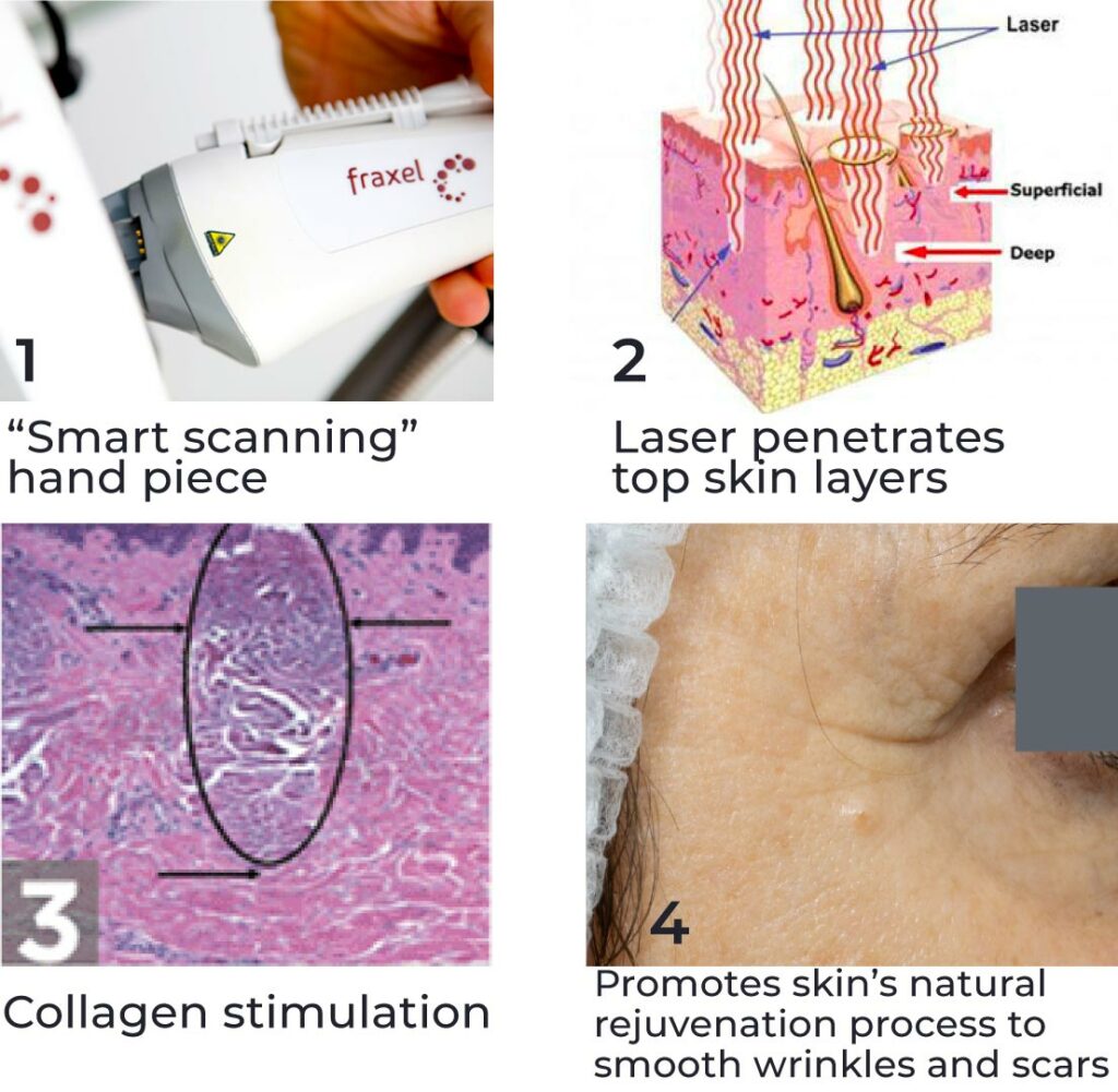 Best Fraxel Laser Packages Brisbane - Cutis Dermatology Best Fraxel Laser Packages Brisbane - Cutis Dermatology