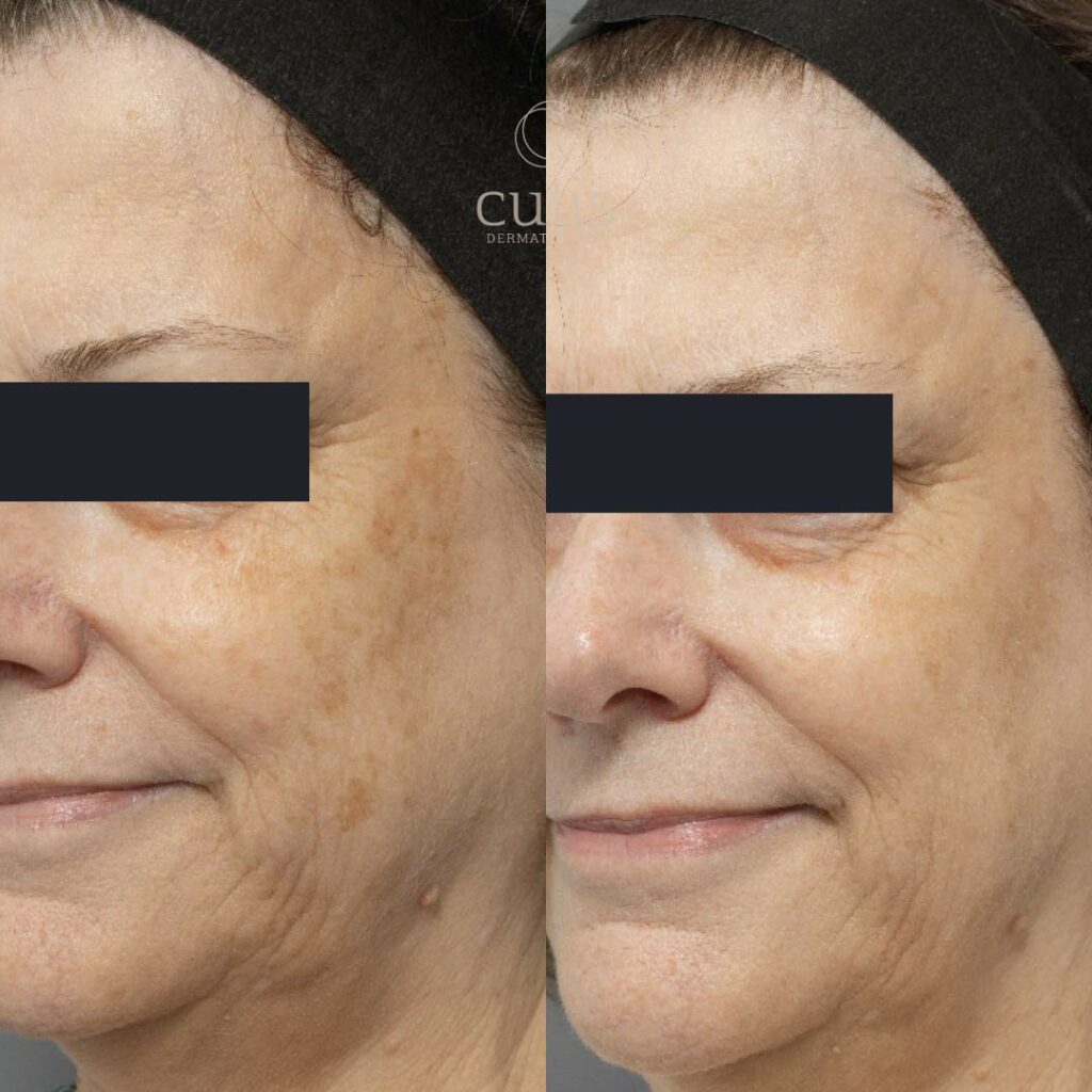 Best Pico Laser Packages Brisbane - Cutis Dermatology Best Pico Laser Packages Brisbane - Cutis Dermatology